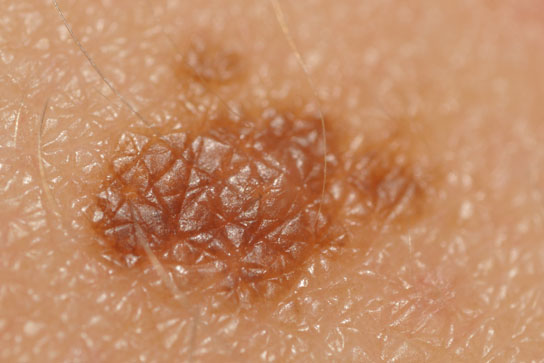 Immune System May Trigger Melanoma Growth Immune System May Trigger Melanoma Growth