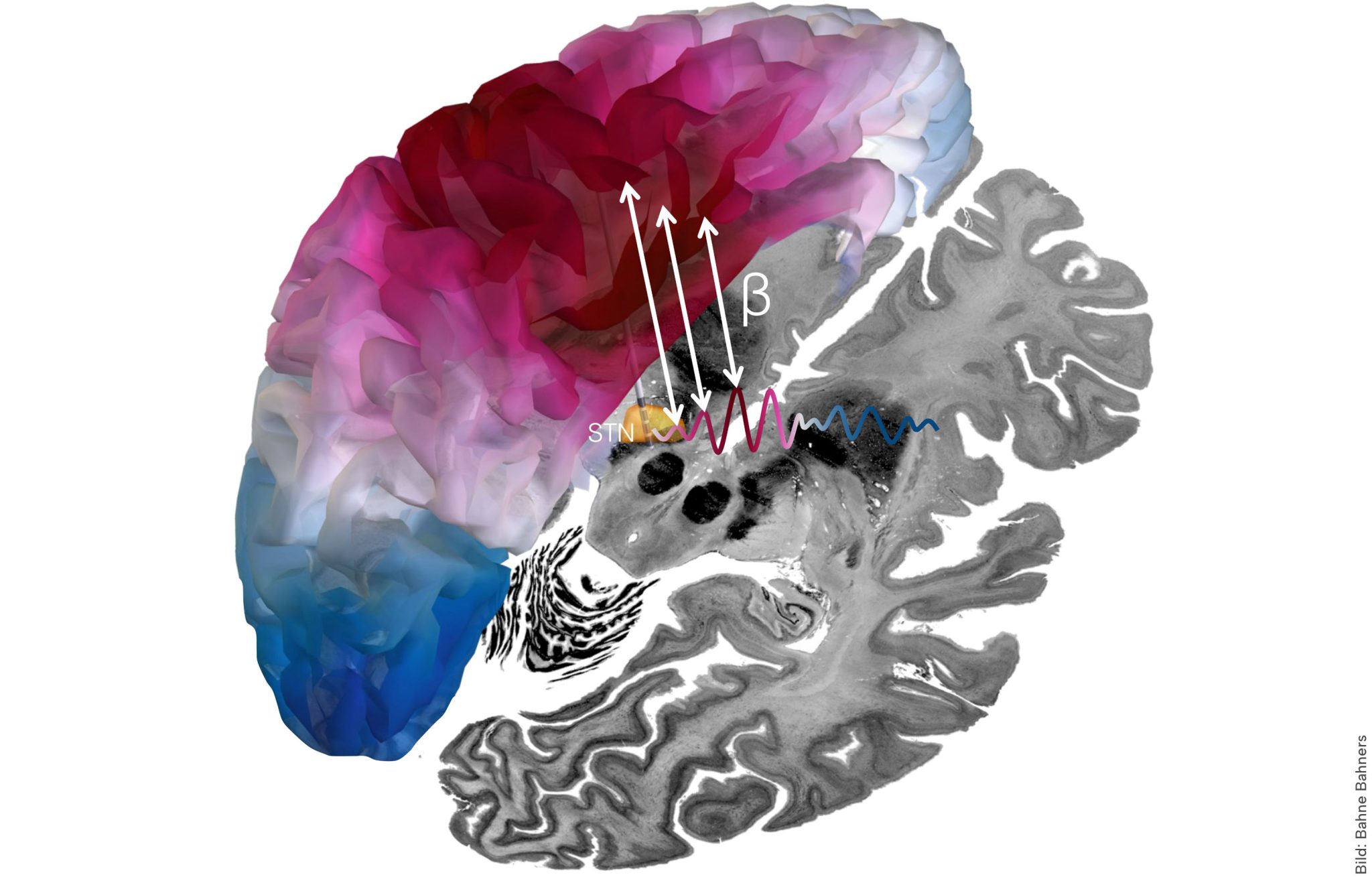 A Hidden Brain Rhythm Could Be the Key to More Effective Parkinson’s ...