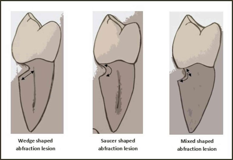 Primate Teeth Just Rewrote a Key Chapter of Human Evolution