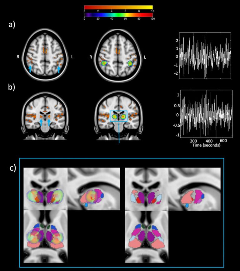 Unveiling Sleep Secrets – How a Tiny Brain Nucleus Impacts REM Sleep ...