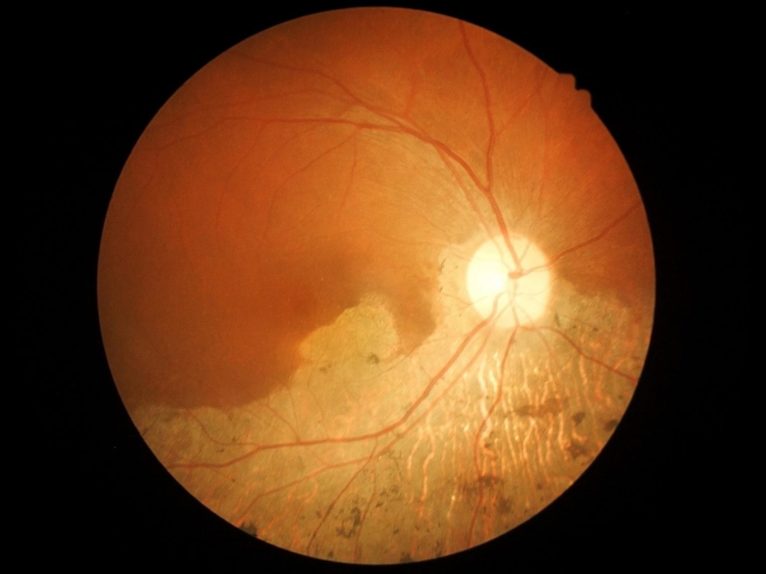 New Mechanism Identified Behind Leading Cause Of Blindness new-mechanism-identified-behind-leading-cause-of-blindness