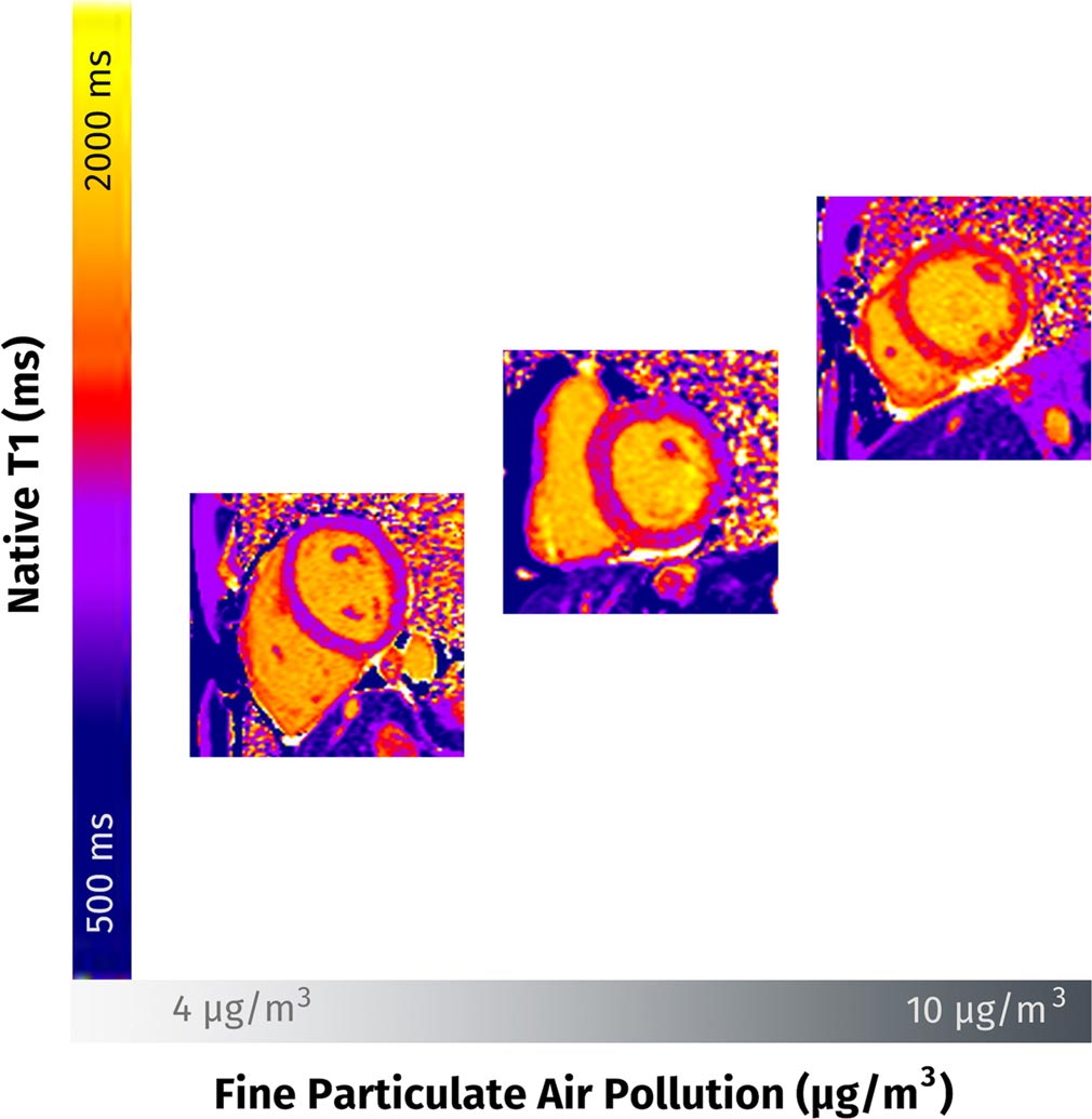 Even “Safe” Air Can Silently Scar Your Heart – MRI Shows How