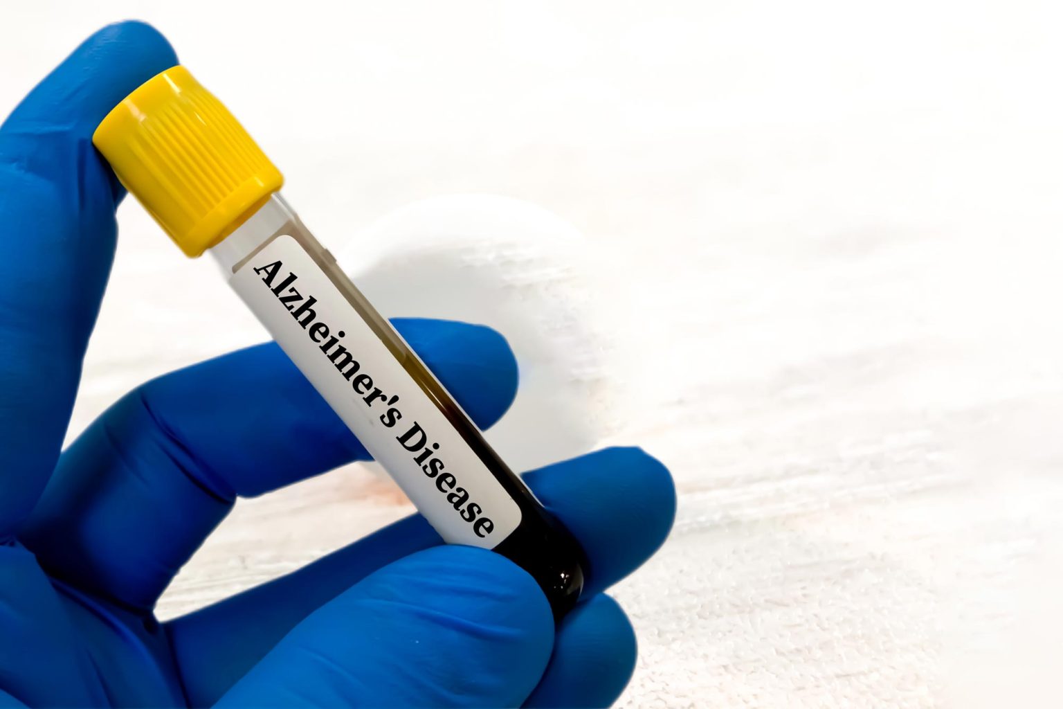 Blood Tests Reveal How Quickly Obesity Accelerates Alzheimer’s