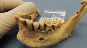 Calcified Bacteria Sheds Light on the Health Consequences of the ...