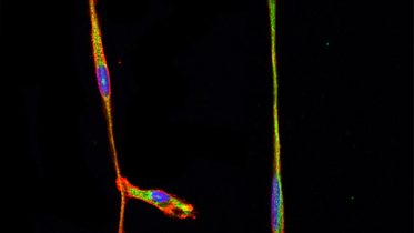 Injecting Bone Marrow Cells Helps Heal the Brain After Stroke