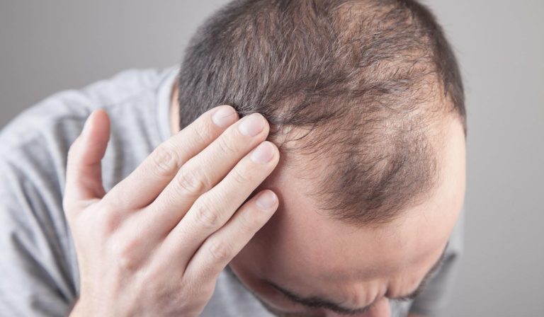 Did Scientists Just Cure Baldness? UCLA’s New Molecule Could ...