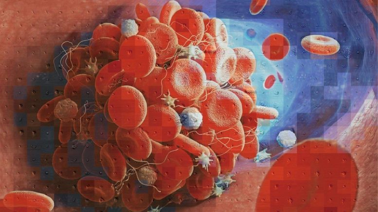 Ultrasonic “Tornado”: A New Faster Way To Break Down Blood Clots