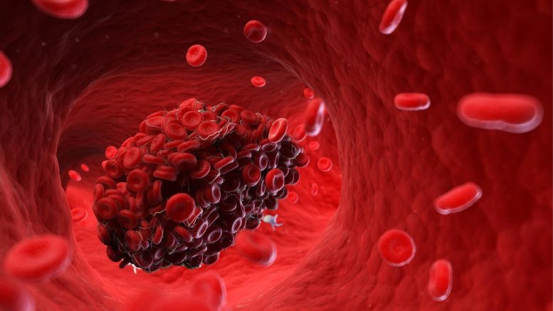 Ultrasonic “Tornado”: A New Faster Way To Break Down Blood Clots