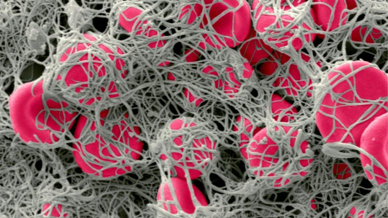 Autoantibodies Causing COVID-19 Blood Clots That Wreak Havoc on Patients