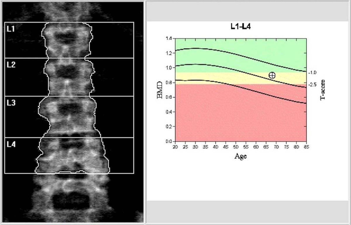 Millions at Risk: Popular Medication Linked to Bone Loss