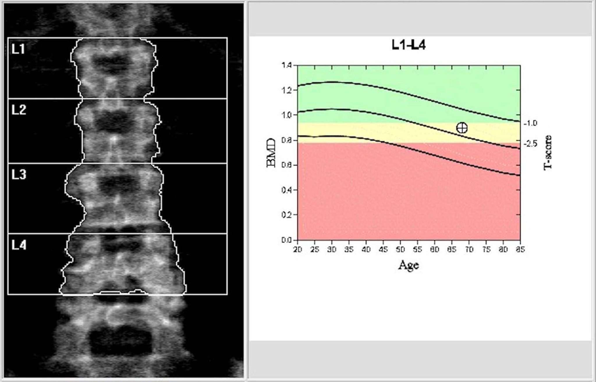 Millions at Risk: Popular Medication Linked to Bone Loss