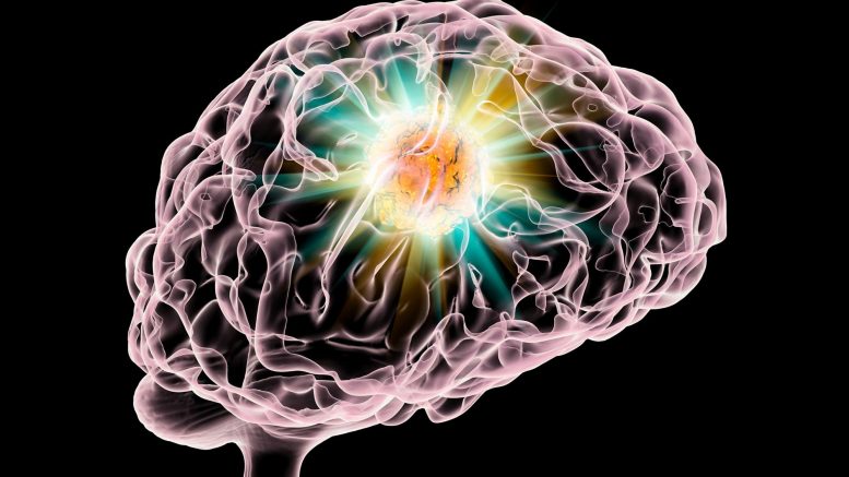 Brain Cancer Breakthrough: Glioblastoma Therapy Doubles Down on Tumor ...