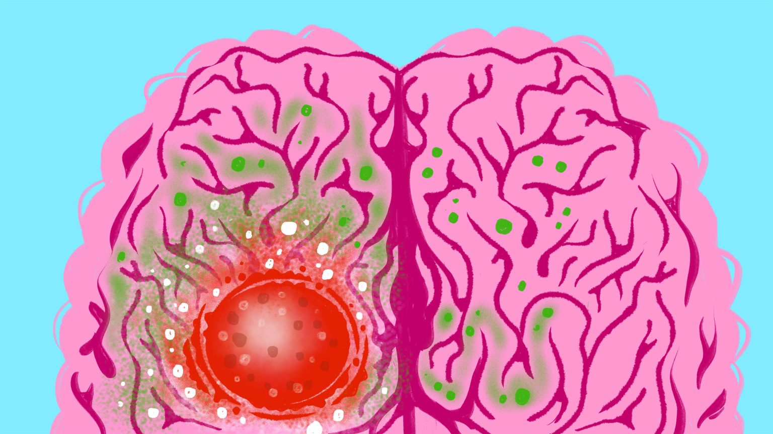 Starving Cancer: New Diet Slows Growth of Deadliest Brain Tumors in Mice