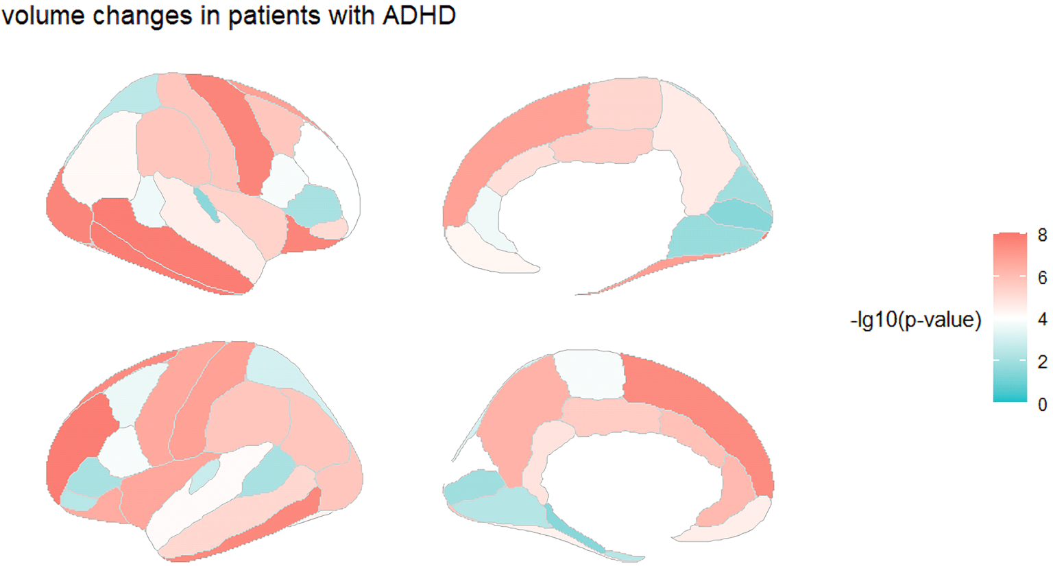 Brain Markers of ADHD Identified in Children’s MRI Scans