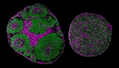 Gene Therapy Reverses Effects of Autism-Linked Mutation in Human Brain ...