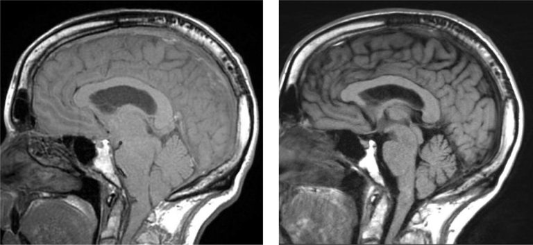 Potential Hidden Cause of Dementia Detected by Cedars-Sinai Research ...