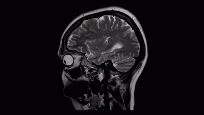 Autism-Associated Brain Differences Can Be Observed in Prenatal MRI ...