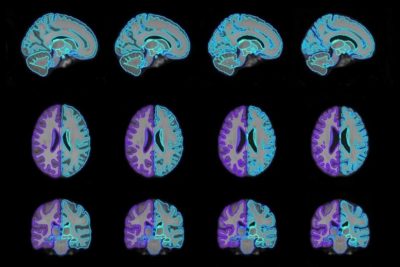 Model Quickly Generates Brain Scan Templates for Medical-Image Analysis
