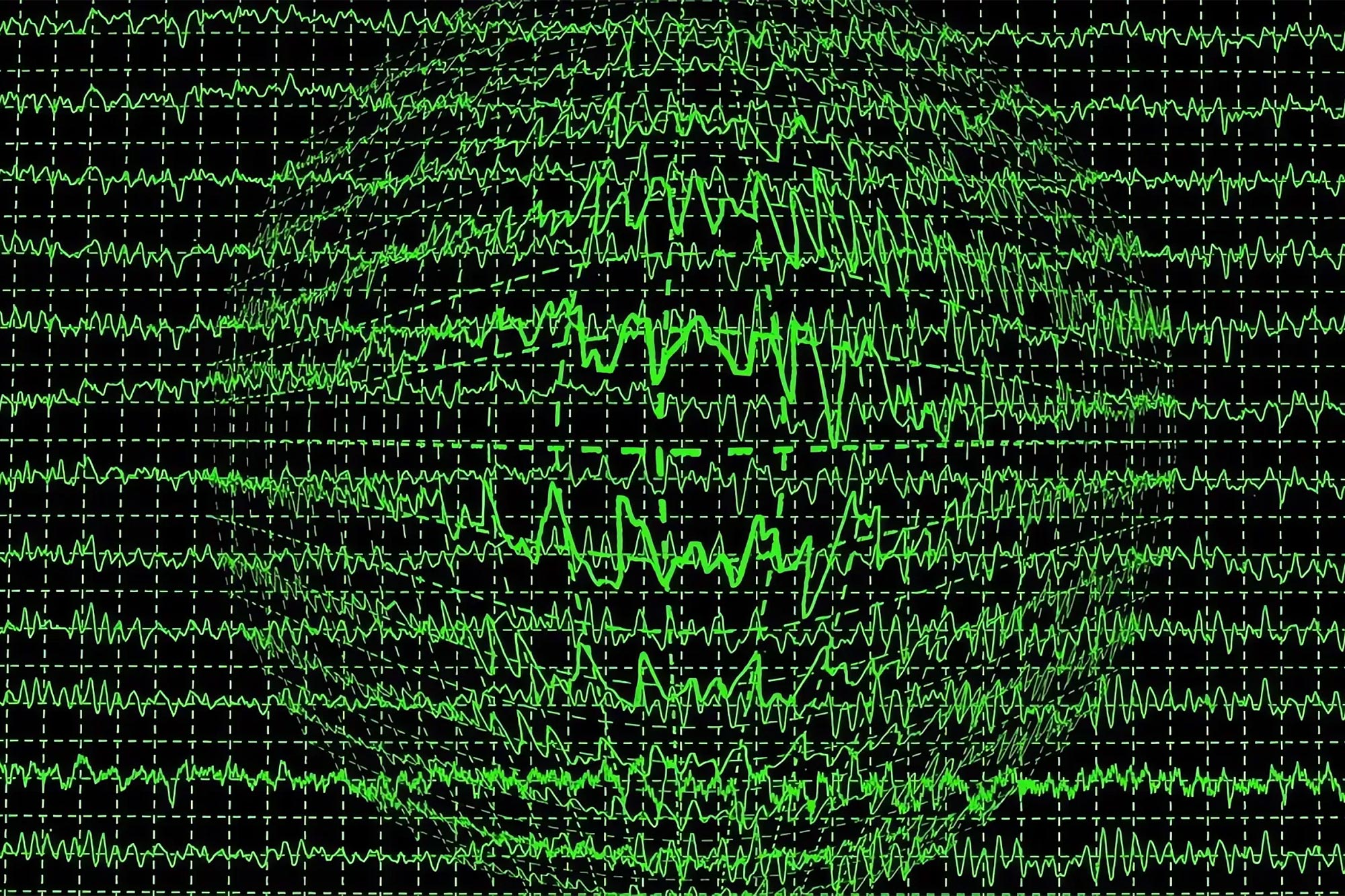 Seizure Brain Waves