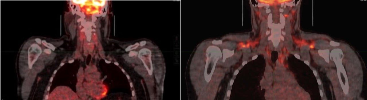 Scientists Discover Why Brown Fat Is Good and How It Can Fight Diabetes ...