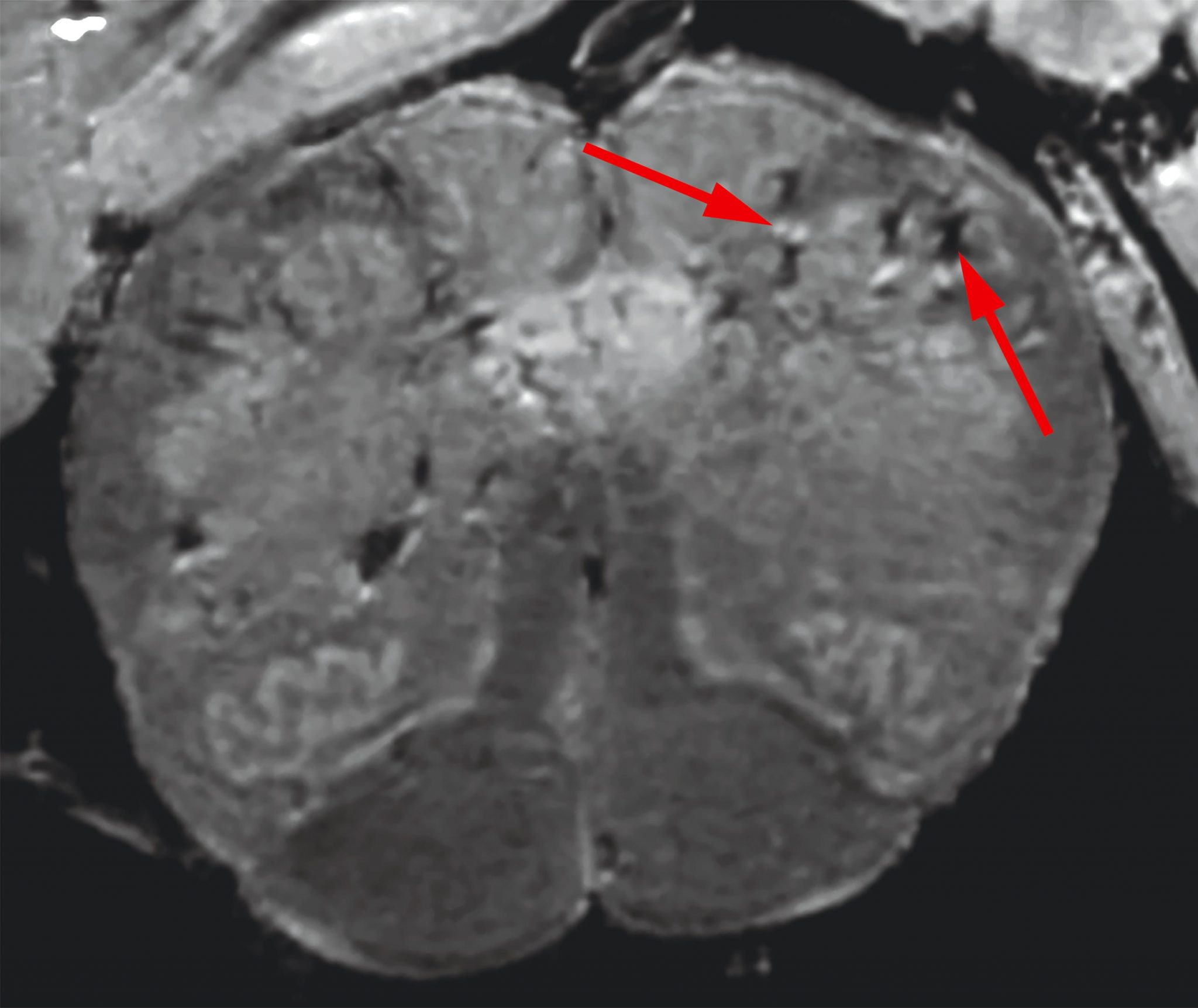 NIH Researchers Uncover Brain Damage in COVID-19 Patients, Despite No ...