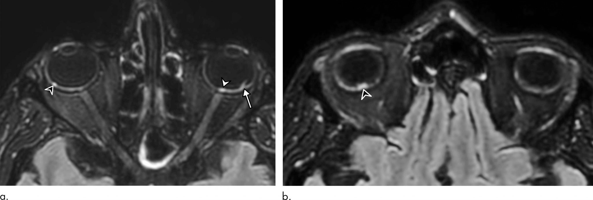 MRI Scans Link COVID-19 to Potentially Dangerous Eye Abnormalities