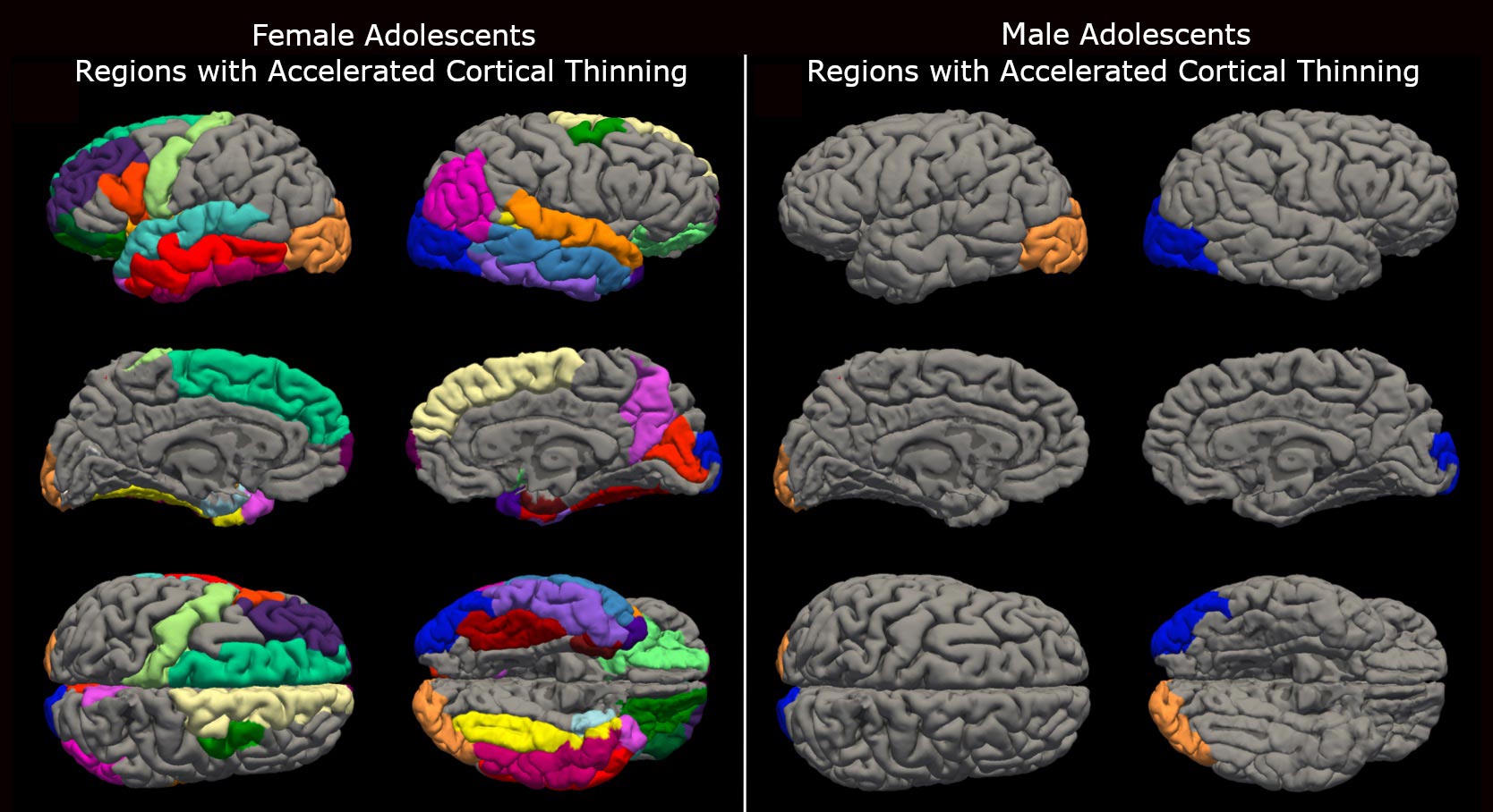 Fast-Forward 4.2 Years: COVID-19 Lockdowns Prematurely Aged Teenage Brains