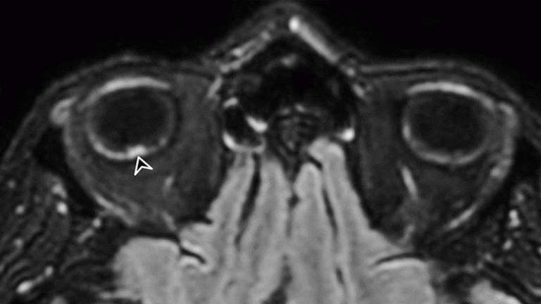 Pink Eye Identified as Possible Primary Symptom of COVID-19