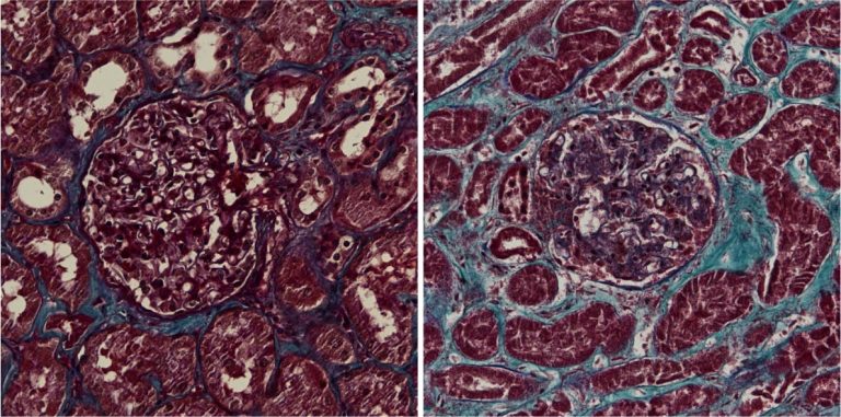 COVID Kidney Damage: Coronavirus SARS-CoV-2 Infects the Kidneys and ...