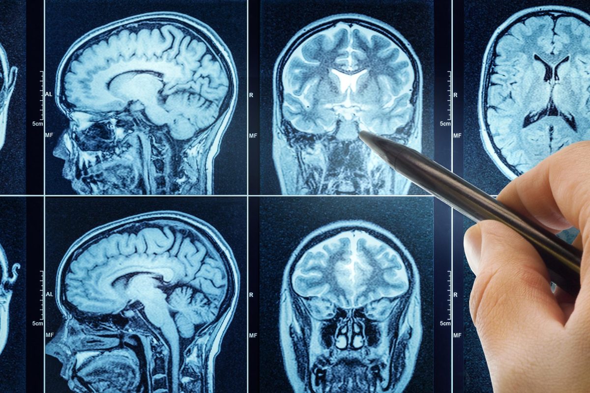 New Brain Signal Predicts Alzheimer’s Years Before Diagnosis