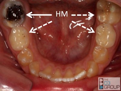 100-Year-Old Mystery of Children’s “Chalky Teeth” Explained – Affects 1 ...