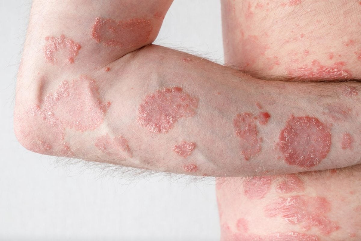 Psoriasis Breakthrough: Scientists Restore Immune Balance Without Harsh ...