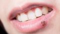Researchers Find Evidence of Link Between Herpes Simplex (Cold Sores ...