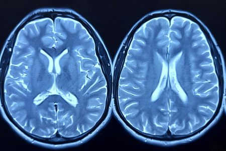 Deep Brain Recordings Reveal How Mounjaro Suppresses Food Cravings