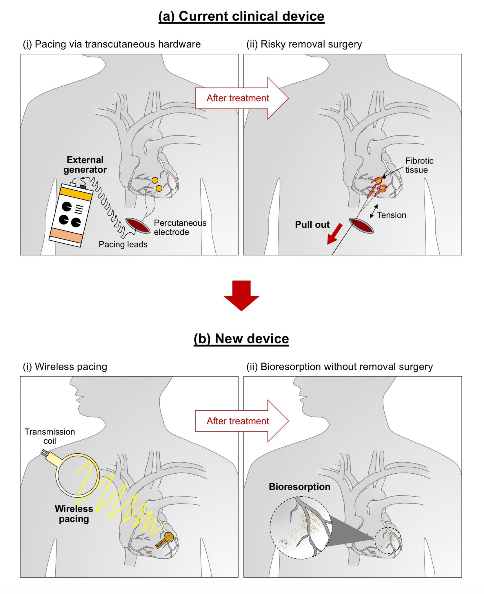 First-Ever Transient Pacemaker Harmlessly Dissolves in Body ...