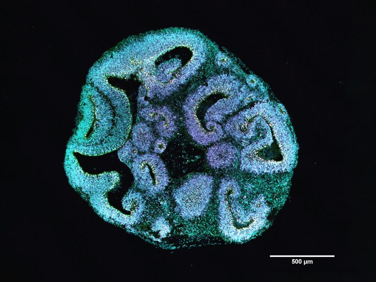 One Small Mutation Can Disrupt Brain Growth for Life