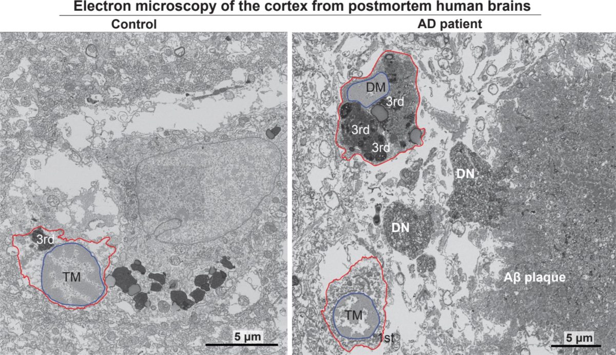 The Hidden Culprit Behind Alzheimer’s Revealed: Microglia Under the ...