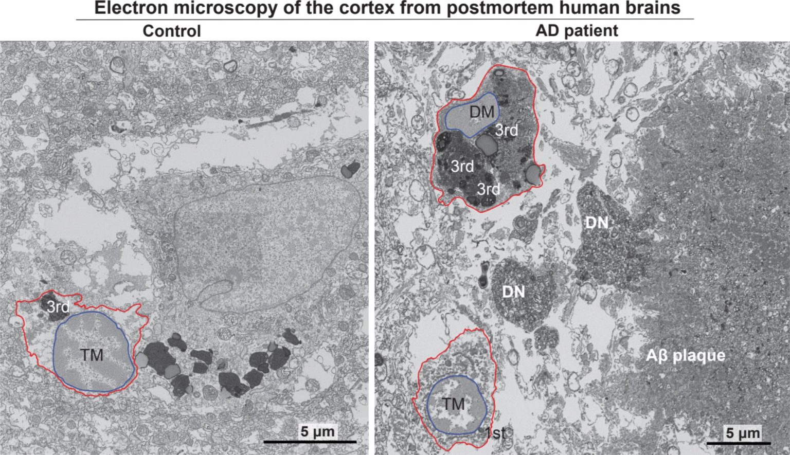 The Hidden Culprit Behind Alzheimer’s Revealed: Microglia Under the ...