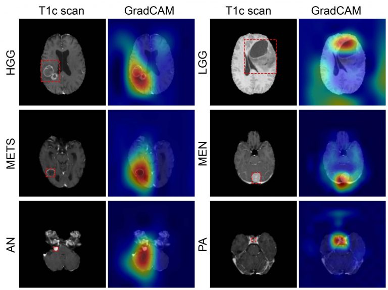 Artificial Intelligence Classifies Brain Tumors With Single MRI Scan