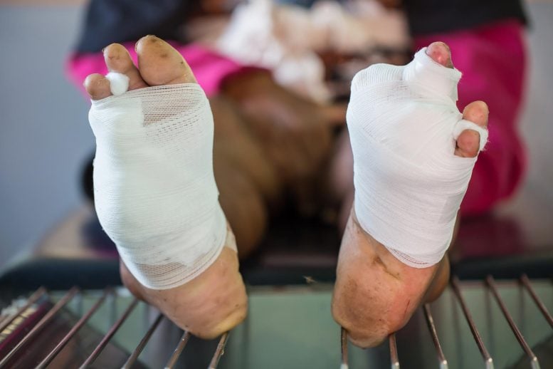 What’s Lurking in Diabetic Foot Wounds May Explain Treatment Failure ...