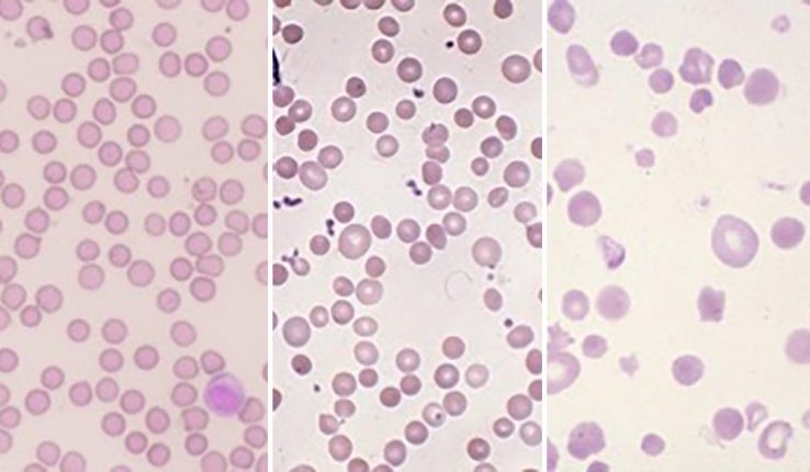 Scientists Crack the Code of a Rare, Inherited Anemia