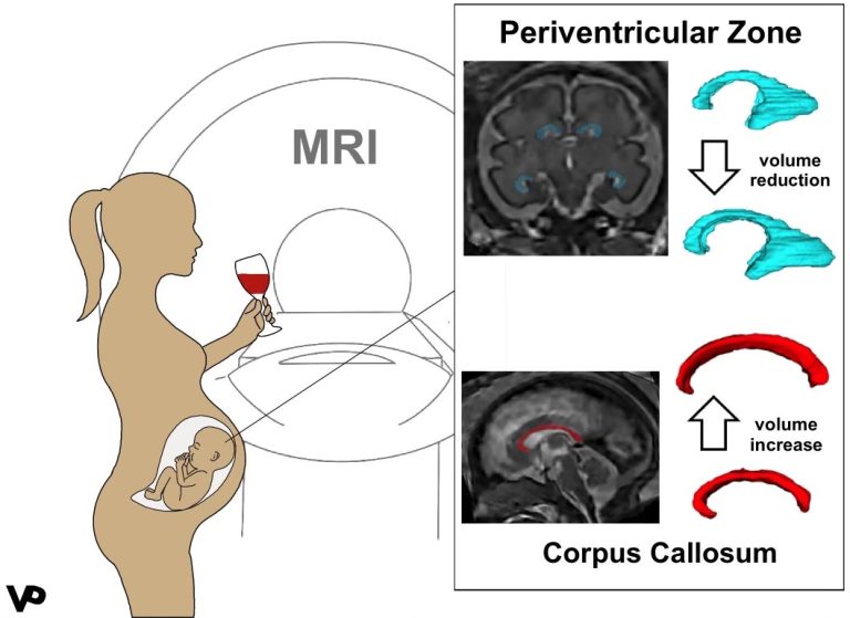 MRI Reveals Significantly Altered Brain Structure in Fetuses Exposed to ...