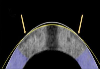 The Shockingly Simple Vision Breakthrough That Might End LASIK