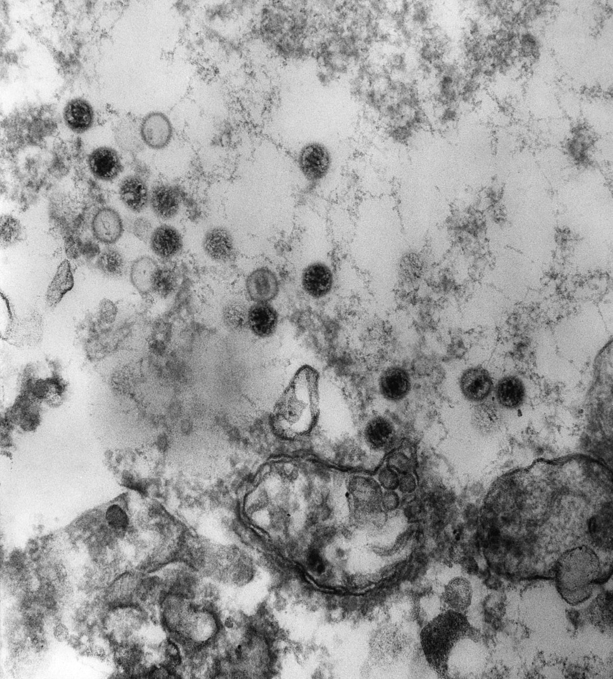 Doctors Uncover How a Dormant Virus Reactivates After COVID and ...