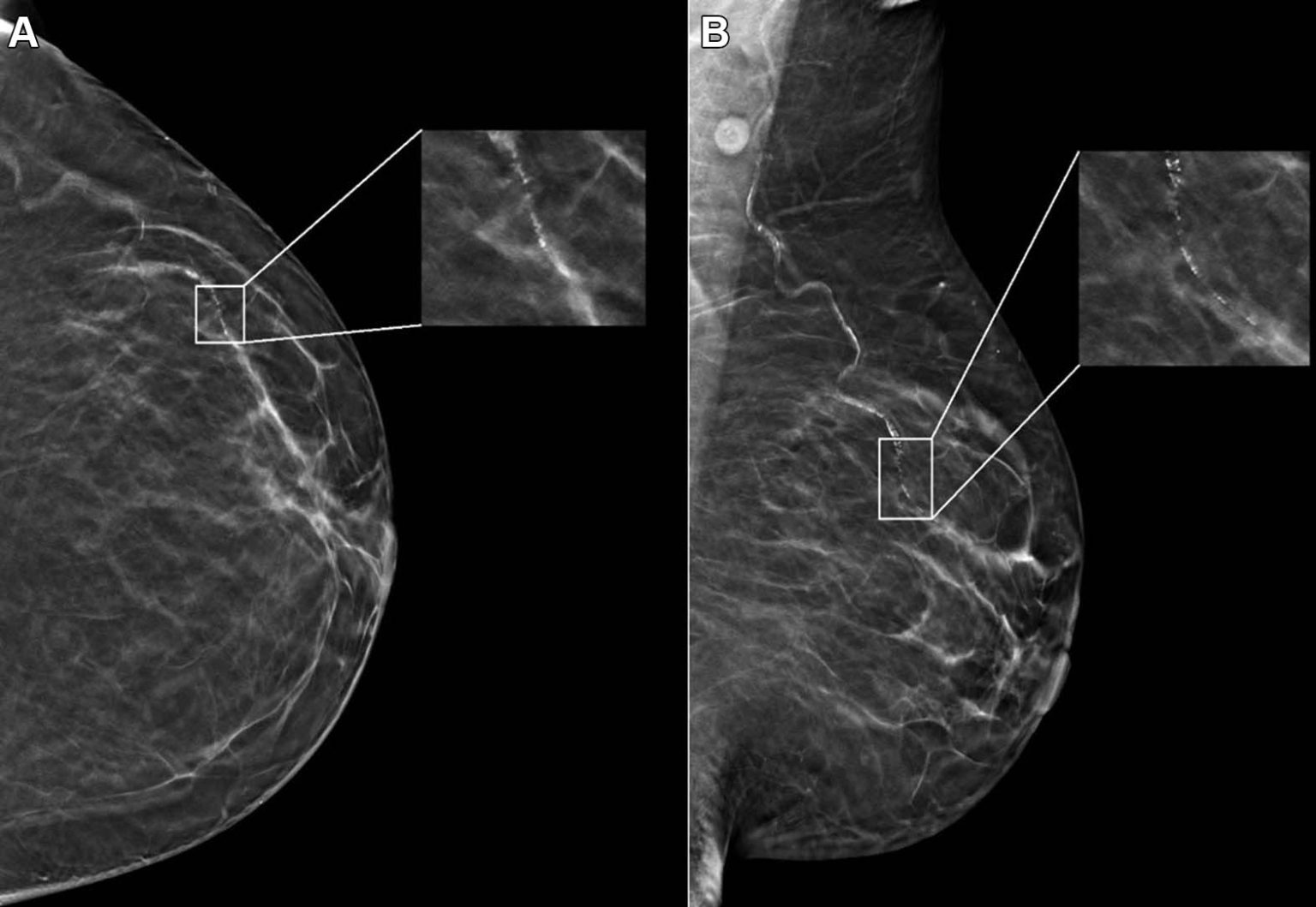 AI's Breast Cancer Blind Spots Exposed by New Study