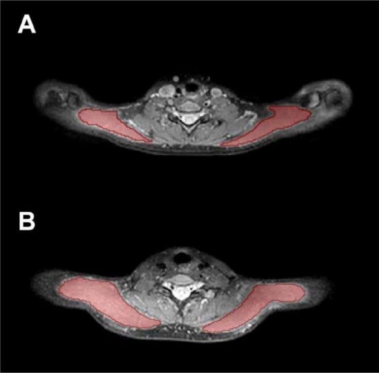 Neck Inflammation: The Hidden Culprit Behind Common Headaches