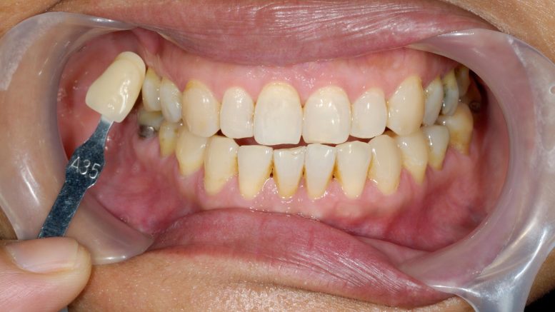 Conceptual Nuclear Reactor Design of High Plutonium Breeding by Light ...