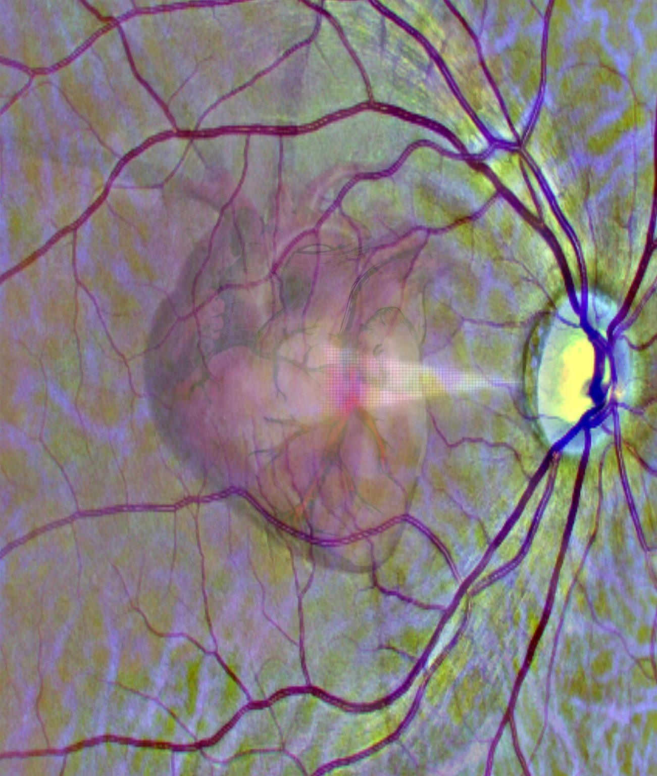 Artificial Intelligence Can Analyze Eye Scans To Identify Patients at ...
