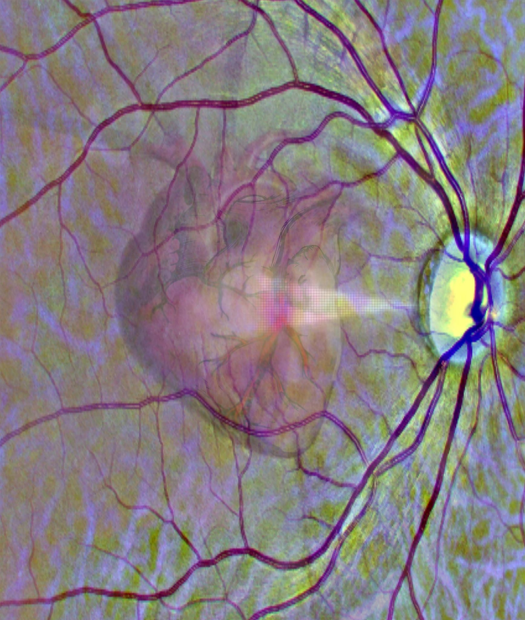 Artificial Intelligence Can Analyze Eye Scans To Identify Patients at ...