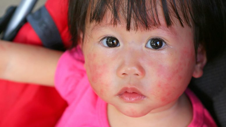 Significant Improvements: A New, Promising Long-Term Treatment for Eczema
